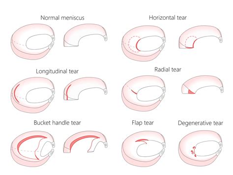 Meniscal Tear Torn Meniscus Knee Education