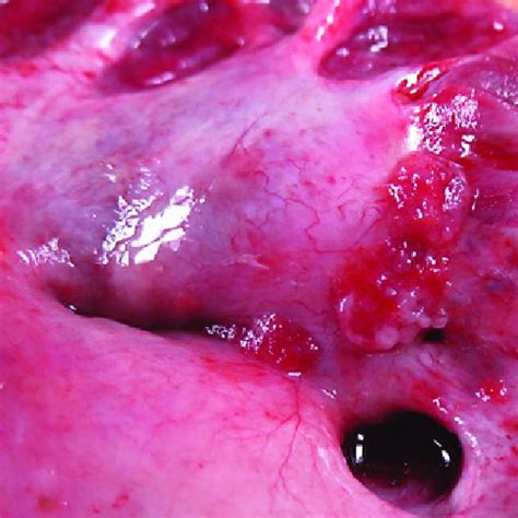 A Papillary Tumor Mm In Diameter Was Detected In Renal Pelvis Of Download Scientific Diagram
