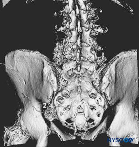 Sciatic Nerve Block Landmarks And Nerve Stimulator