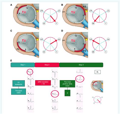 Right Sided Accessory Pathways With Qrs Transition V3 Schematic Download Scientific Diagram