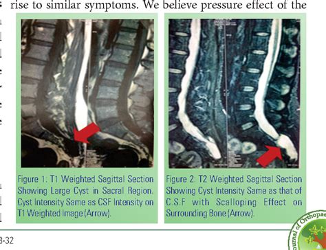 Figure 2 From Scalloping Sacral Arachnoid Cyst As A Cause Of Perianal