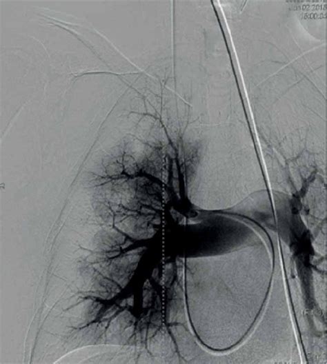 Patient With Inoperable Chronic Thromboembolic Pulmonary Hypertension