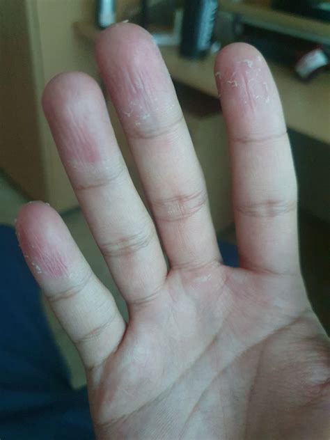 피부 증상은 뭐고 무슨약 발라야하나요 지식in