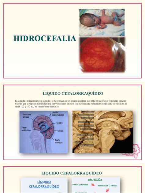Hidrocefalia Caso De Graziely Alves Régis Pdf Fluido