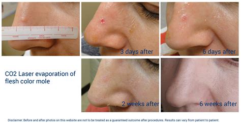 Facial Nevi International Vein And Skin Institute