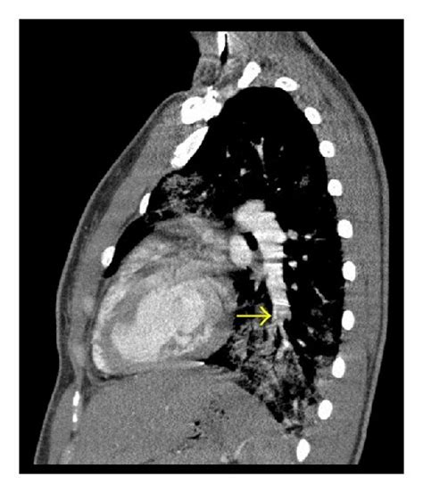 Volumetric Computed Tomography Acquisition Of The Chest From The Download Scientific Diagram