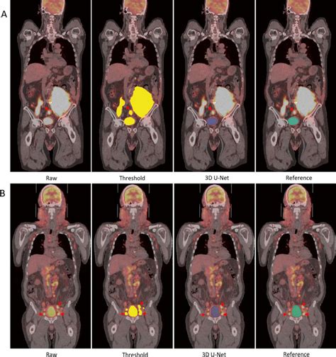 Example Of Bladder Segmentation With Tumor Nearby Indicated By Red Download Scientific Diagram