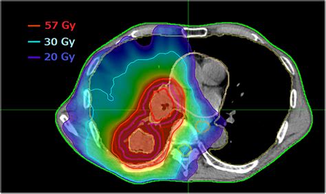 Representative Actual Treatment Plan Of Intensity Modulated