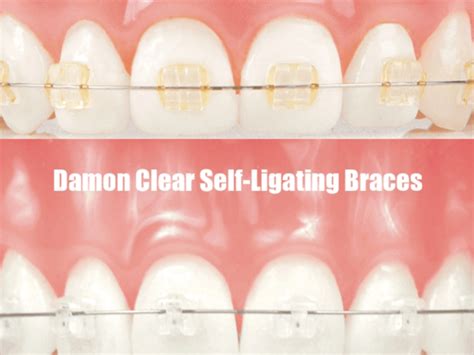 Conventional Braces Vs Self Ligating Braces An In Depth Guide