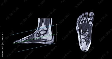Mri Foot Scan For A Diagnostic Tool Used To Image The Structures Of The