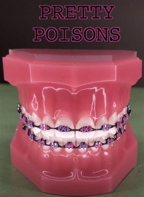 Pin By A J On Ginger Braces Colors Getting Braces Braces Tips