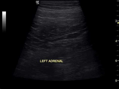 Hypoadrenocorticism Members