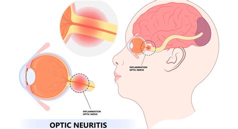 Optic Neuritis Vs Normal