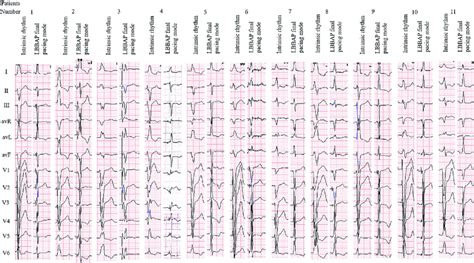 One Beat Of Intrinsic Rhythm With Left Bundle Branch Block Lbbb And 1 Download Scientific