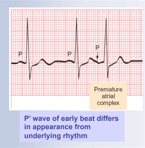 Ekg Supraventricular Complexes Flashcards Quizlet