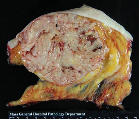 Phyllodes Tumor Mgh Learn Pathology