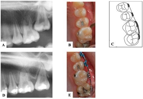 Ectopic Permanent Molars A Review