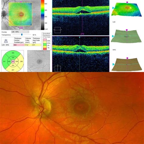 Cool Finding At Work Today Roptometry