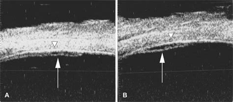 Vitreous Incarceration In Sclerotomies After Valved 23 25 Or 27
