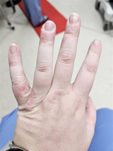 My Hands Are Falling Apart And Have Been For Months R