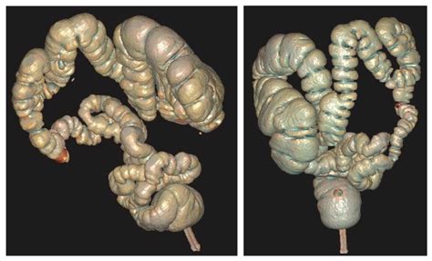 3d Reconstruction Of Colon With Tortuous Sigmoid Colon 3d Download Scientific Diagram