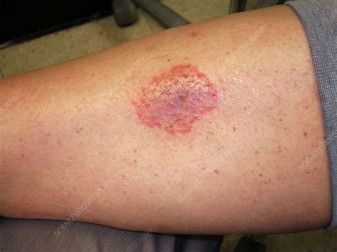 Pigmented Purpuric Dermatosis Stock Image C0564968 Science Photo