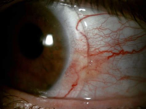 Scleral Lens Education Society On Linkedin “this Dry Eye Patient