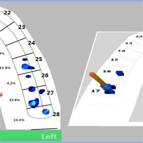 Pdf Force Distribution On Occlusal Splint Using T Scan Occlusal Analysis