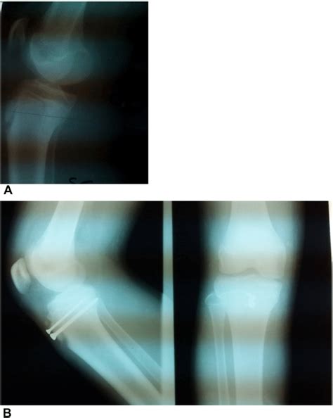Tibial Tubercle Fracture Of Case 1 A Fracture With The Presence Of