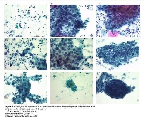 Figure 1 From Characteristic Cytological Features Of Cervical Clear