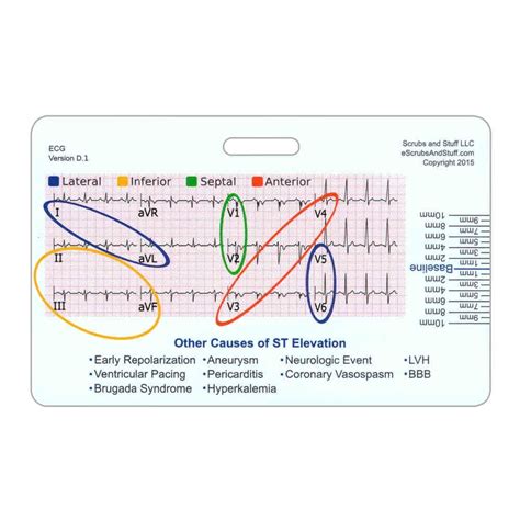 12 Lead Stemi Chart Educational Chart Resources