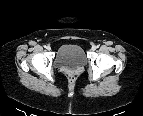 Filecholedocholithiasis Cholangitis And Portal Vein Thrombophlebitis