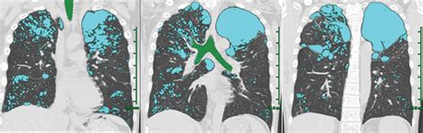 Oxygen Enhanced Mri Thin Section Mdct And Perfusion Spectct
