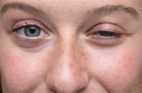 Mata Sayu Ini Penyebab Dan Cara Mengatasinya