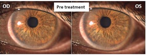 Adenoviral Keratitis