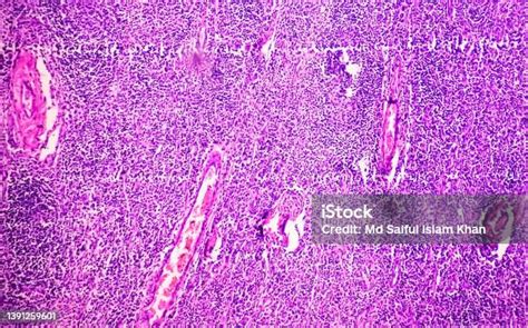 상피 조직세포는 결핵의 현미경 검사 기준에서 본다 만성 육아 종성 염증 Cgitb 세포에 대한 스톡 사진 및 기타 이미지 세포 0명 거대세포 인간의 세포 Istock