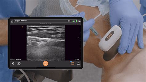 Usg Interscalene Block Clarius