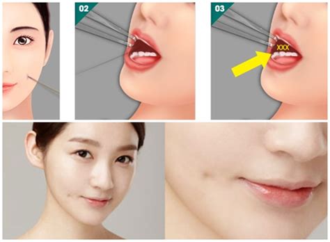 Tạo Má Lúm đồng Tiền Làm Duyên Lại Thành Vô Duyên
