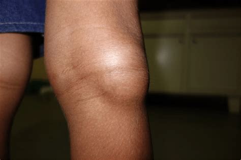 Clinical Photograph Of The Right Popliteal Fossa Swelling Download Scientific Diagram