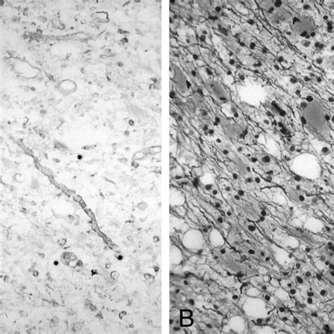Photomicrographs Of A Biopsy Specimen From A Tumefactive Demyelinating
