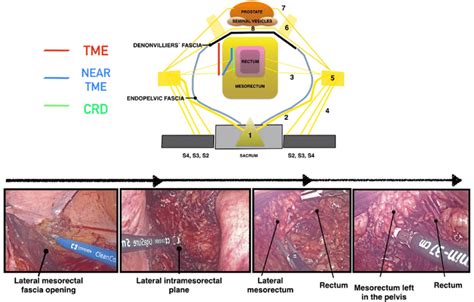 Drawing And Laparoscopic Dissection Comparing Close Rectal Dissection Download Scientific