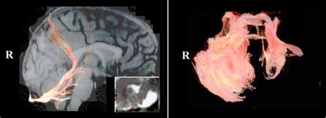 Dti Based Deterministic Tractography Tract Reconstructed Using A Seed