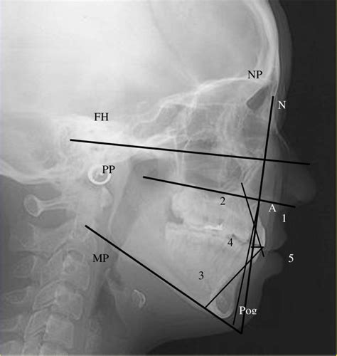 Dental Parameters 1 Skeletal Convexity Angle 2upper Incisorpp Download Scientific Diagram