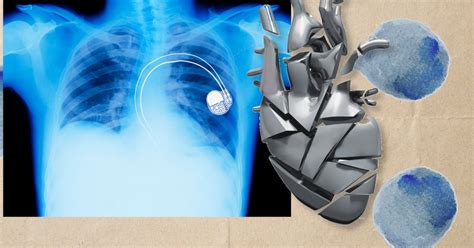 Un Défaut Détanchéité Signalé Sur Des Pacemakers De La Marque Abbott Lansm Alerte Les 16300