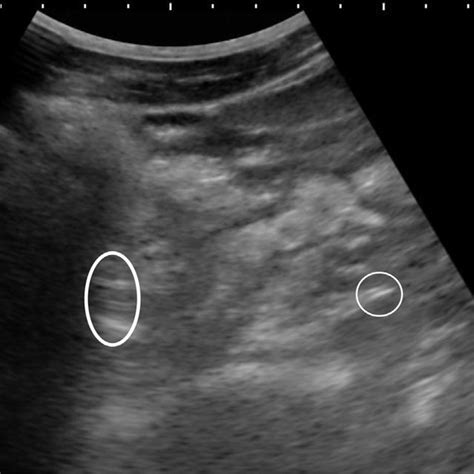 Placenta From Pih Mothers A Placenta Showing Calcification Arrows Download Scientific