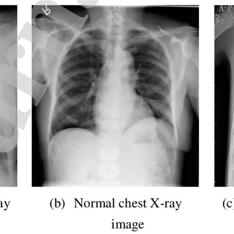 Sample Of Chest X Ray Images Download Scientific Diagram