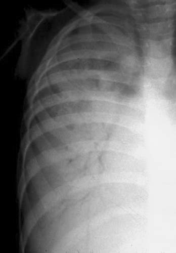 Week 3 Pneumonia Airspace And Interstitial Disease Lateral Cxr Flashcards Quizlet