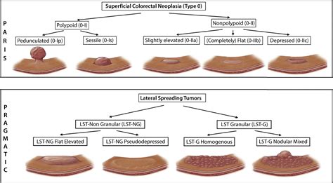 Use Of The Aces Appearance Classification Enhanced Endoscopy And