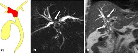A Drawing Illustrates Bismuth Corlette Type Iiia Tumor B Mrcp And C