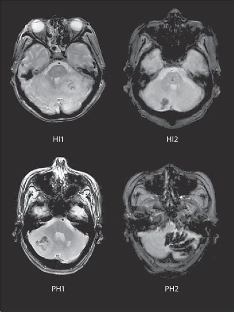 Figure 1 From Hemorrhagic Transformation In Acute Cerebellar Infarction Semantic Scholar